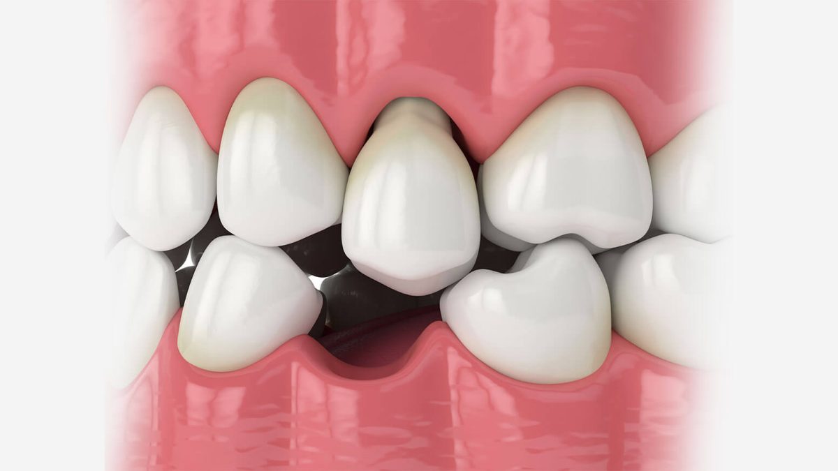 Why are back teeth important Why Replace back teeth