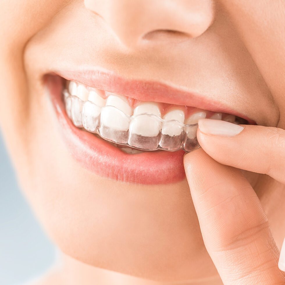 Invisalign Near Morningside | Balmoral Dental Centre
