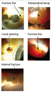 Dental Transillumination|Dental Diagnosis|Local Dentist
