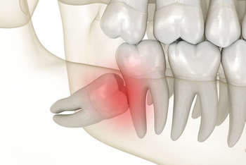 Wisdom Tooth Pain: Causes, Relief, And Treatment Options