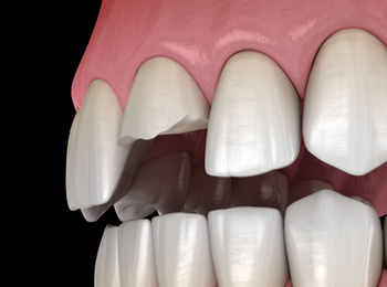 Tooth Cap vs Crown: Key Differences, Costs, and Types