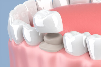 Tooth Cap vs Crown: Key Differences, Costs, and Types